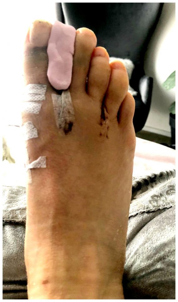 Bunion Surgery 2 Week Post-Operation Update — Inside Out Style